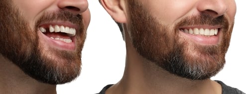 What Are Dental Implants?